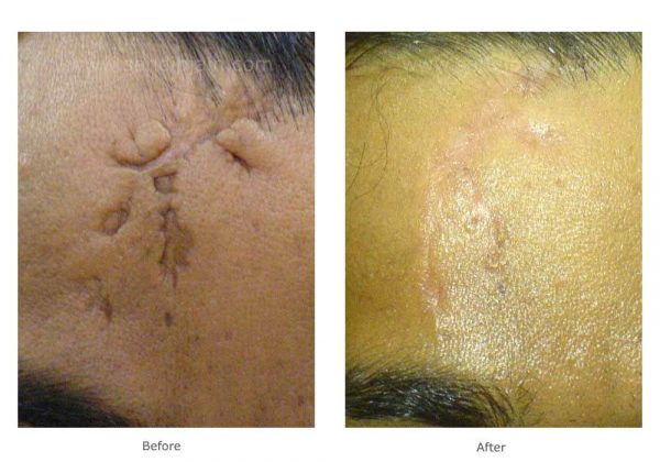 Safe and Smooth Scar Removal Surgery | Cosmetic Surgery