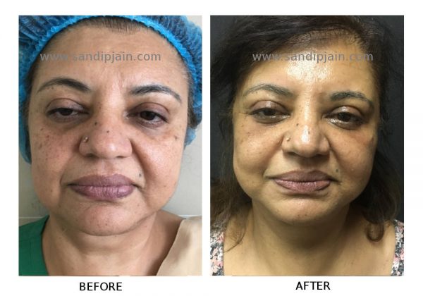 Face Lift Surgery | Face Lift Procedure | Dr Sandip Jain